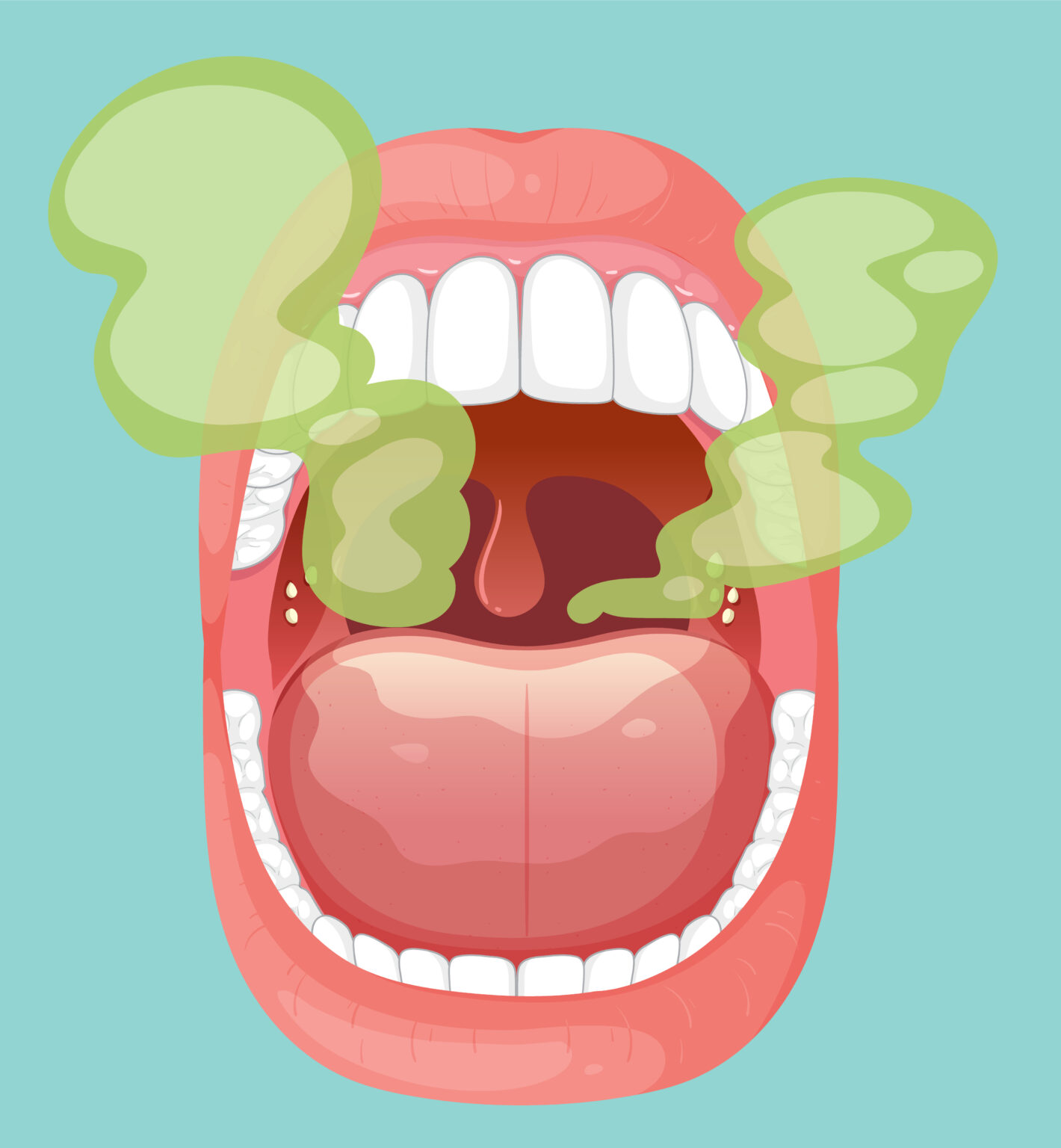 How To Get Rid Of Tonsil Stones 101: The Ultimate Guide To Tonsil Stone ...